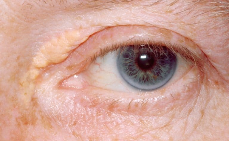 Xanthelasma Removal from £495 | Skin Surgery Clinic