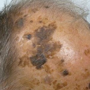 Seborrhoeic Warts (Keratosis) - Skin Surgery Clinic