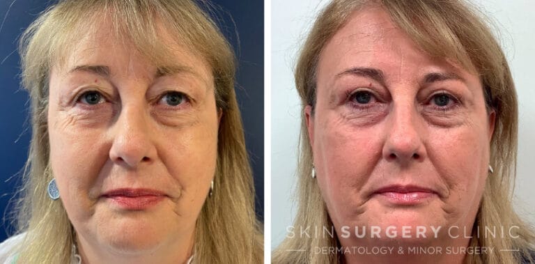 Dawn's Upper Blepharoplasty Testimonial - Skin Surgery Clinic