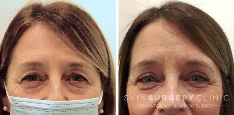 Lynne's Amazing Eyelid Surgery Results - Skin Surgery Clinic