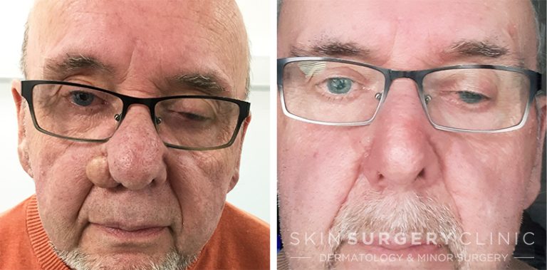Rhinophyma Treatment: "my self confidence had gone" - Skin Surgery Clinic