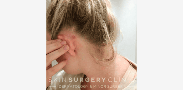 Skin Cancer: "Get it checked. You're important." - Skin Surgery Clinic