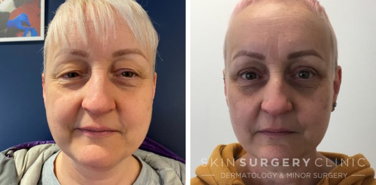 Eyelid Lift Surgery: "I'm amazed.. I was starting to look like an old ...