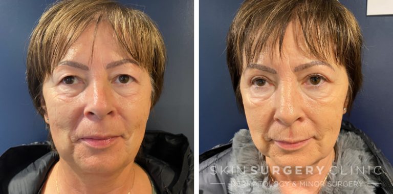 Upper Blepharoplasty: "I have my confidence back" - Skin Surgery Clinic
