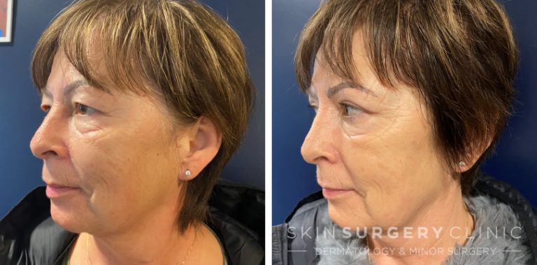 Upper Blepharoplasty: "I have my confidence back" - Skin Surgery Clinic