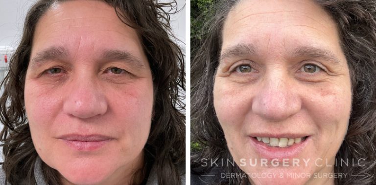 Upper Blepharoplasty - "I am extremely happy and from day 1 post ...