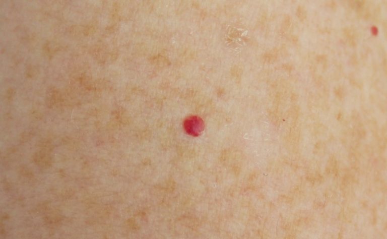 Cherry Angioma Removal - Skin Surgery Clinic