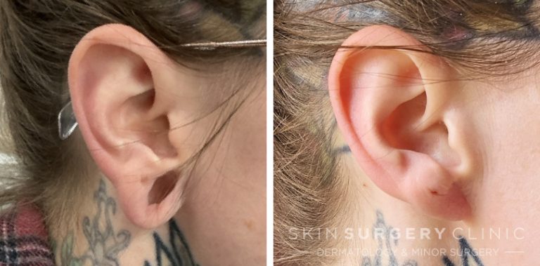 Earlobe Reconstruction: "I feel so much happier and more confident ...